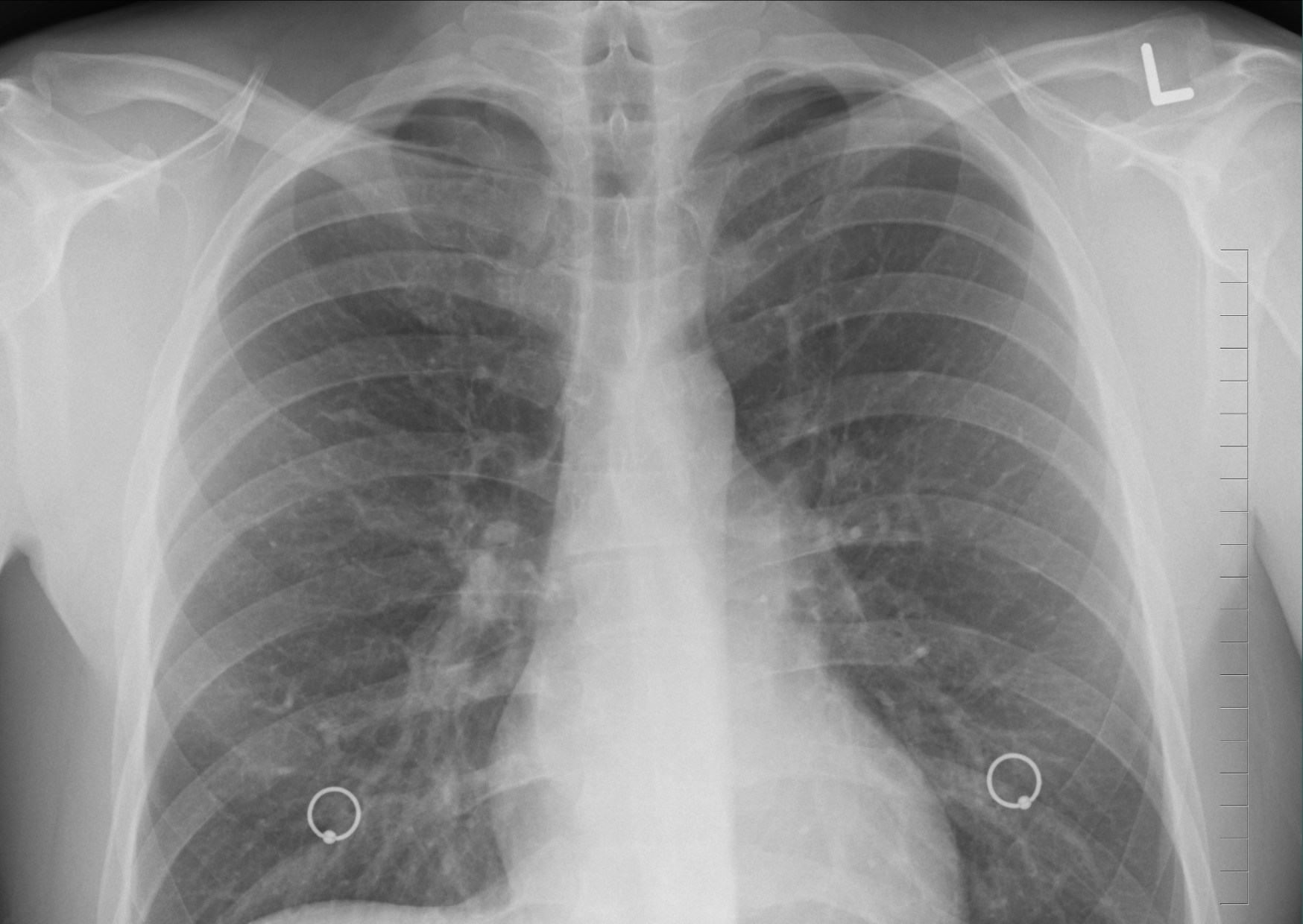 Rentgenogrāfija (rentgena izmeklējums, RTG)