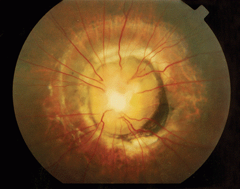 Morning glory sindroms