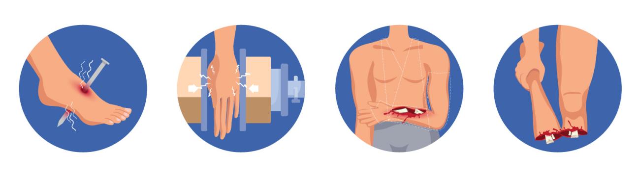Traumatiska amputācija