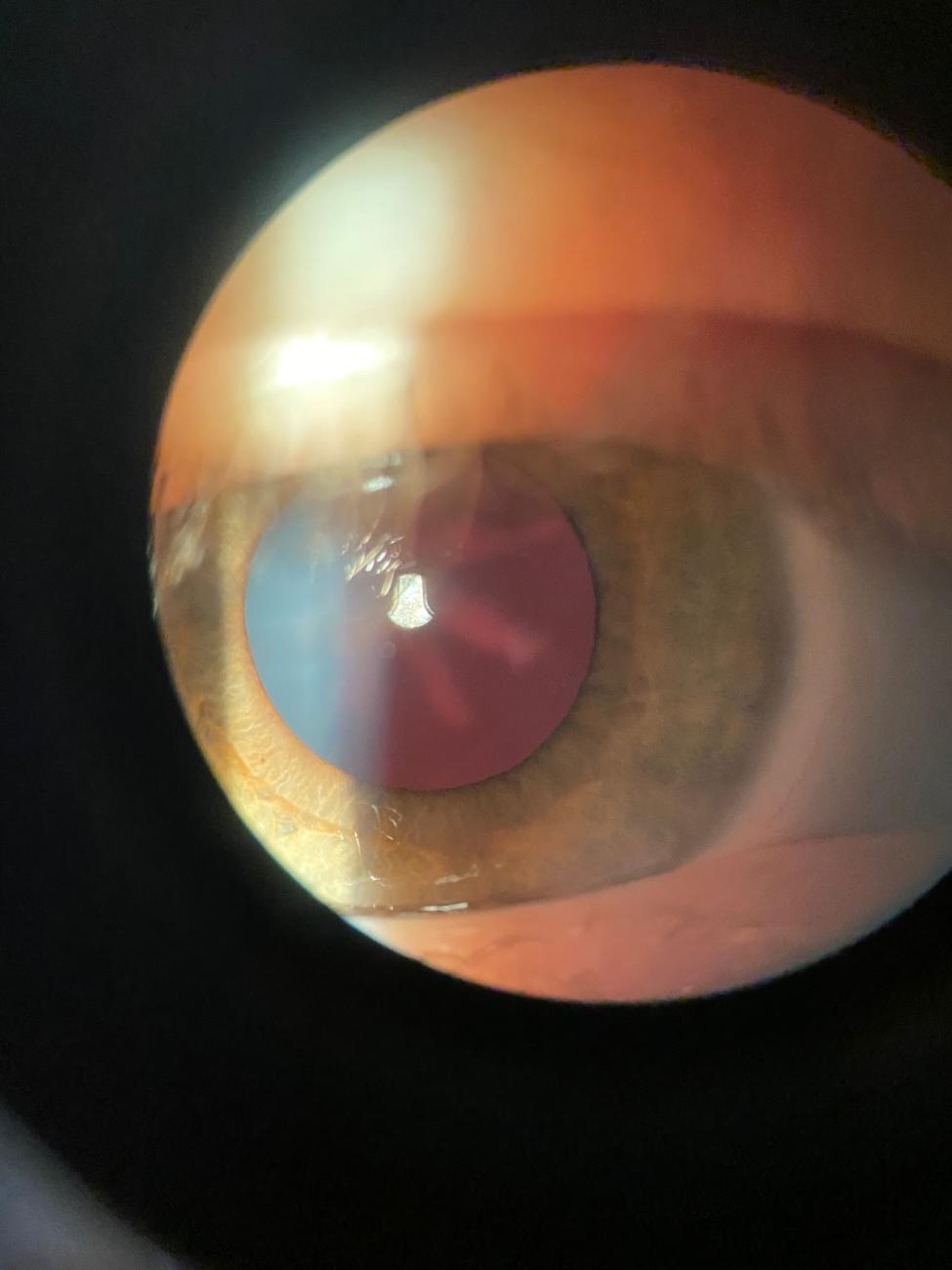 Diabētiska radzenes neiropātija