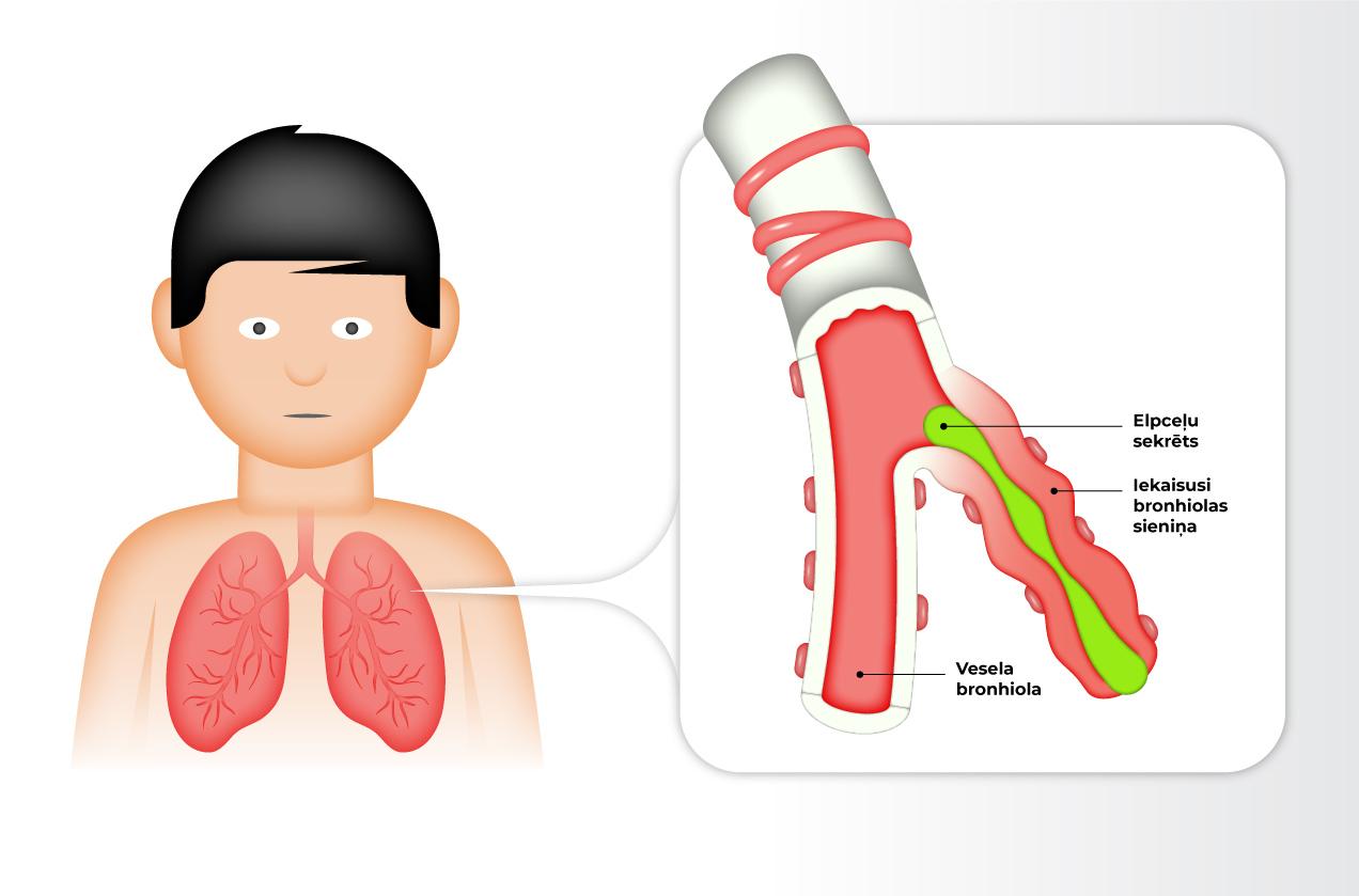 Bronhiolīts (akūts)