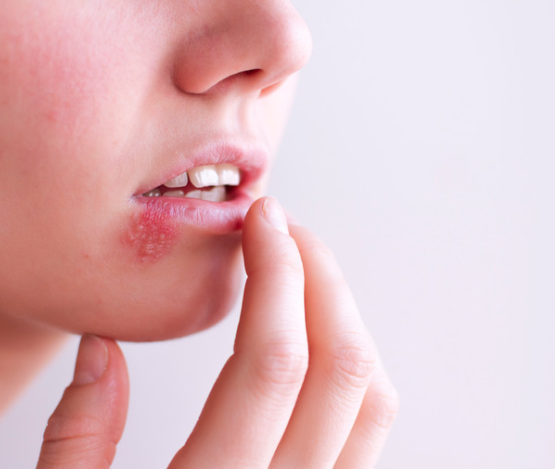 Herpes simplex infekcija